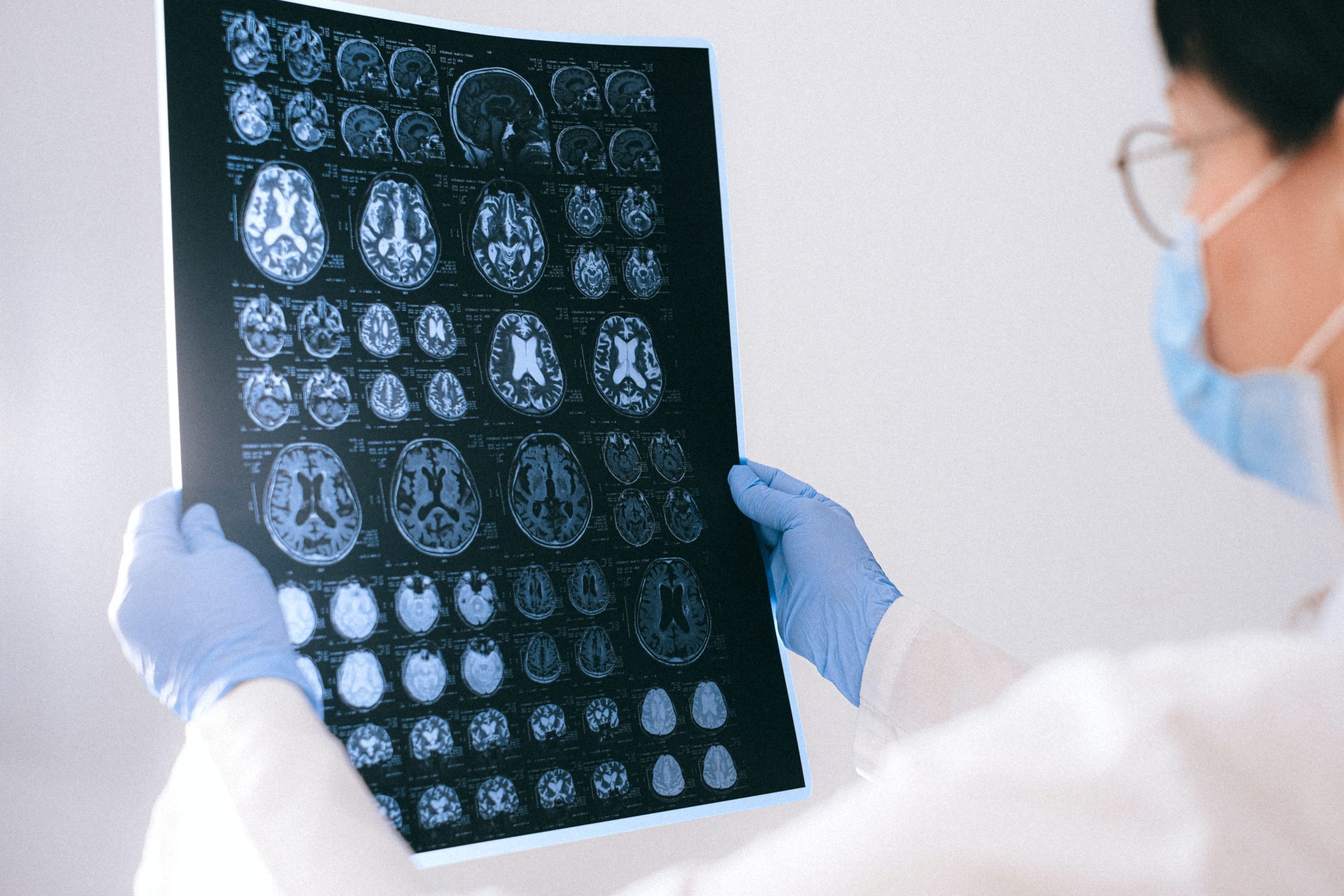 Case Report: Lance-Adams Syndrome - Sharoon David